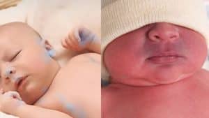 Blue Baby Syndrome Explained: Causes, Symptoms & Early Action Steps ...